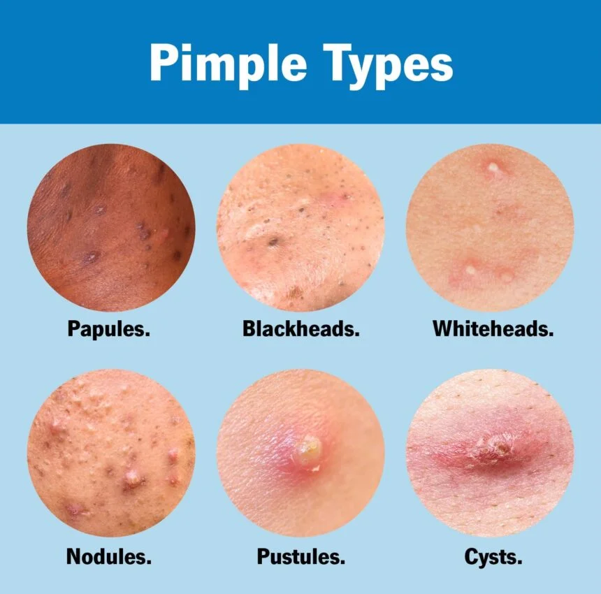 Why Acne on the Nose Is So Common — and What It Really Means - Thousand ...
